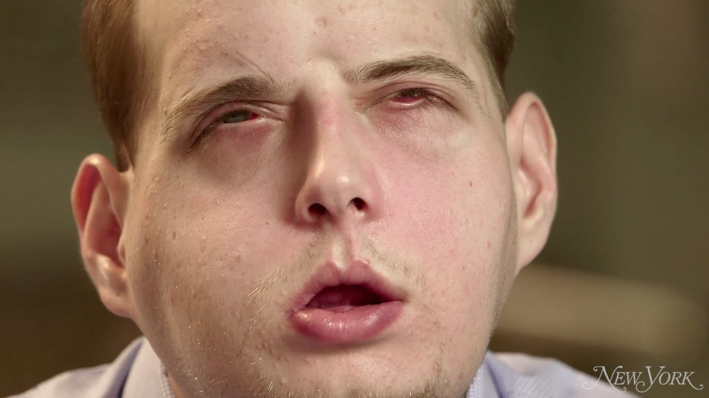 Firefighter Gets Full Facial Transplant | Firehouse