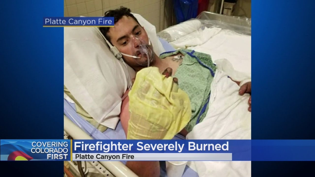 CO Firefighter Recovers from Severe Burns During House Blaze | Firehouse